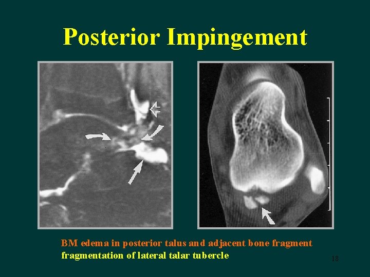 Ankle Impingement Syndrome initial ankle injury abnormal osseous