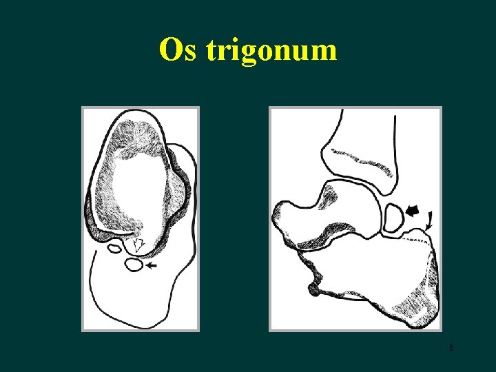 Ankle Impingement Syndrome initial ankle injury abnormal osseous