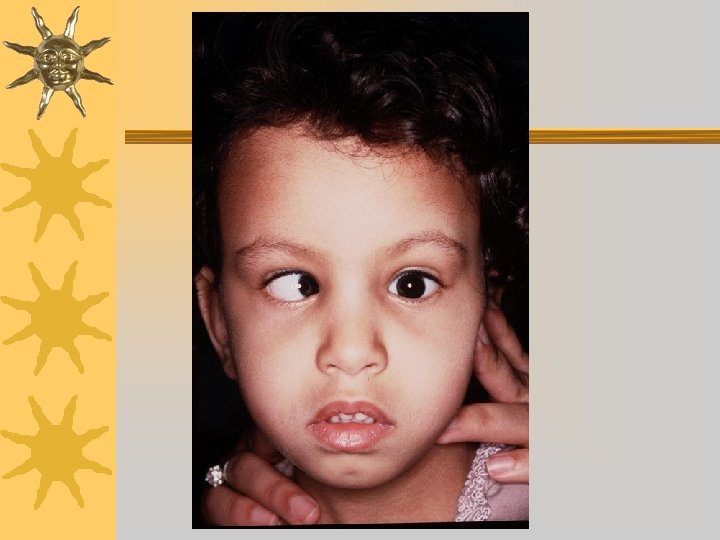 Strabismus 1 ocular misalignment due to extraocular muscle