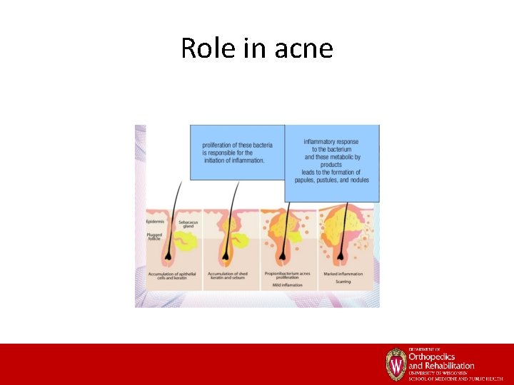 Preventing C Acnes Infections Where are we now