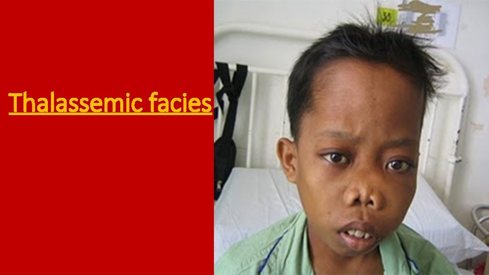 Structure of Haemoglobin THALASSEMIA It result from reduced