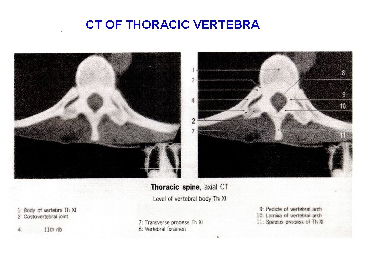 MEDICAL IMAGING OF THE VERTEBRAE Vertebrae are your
