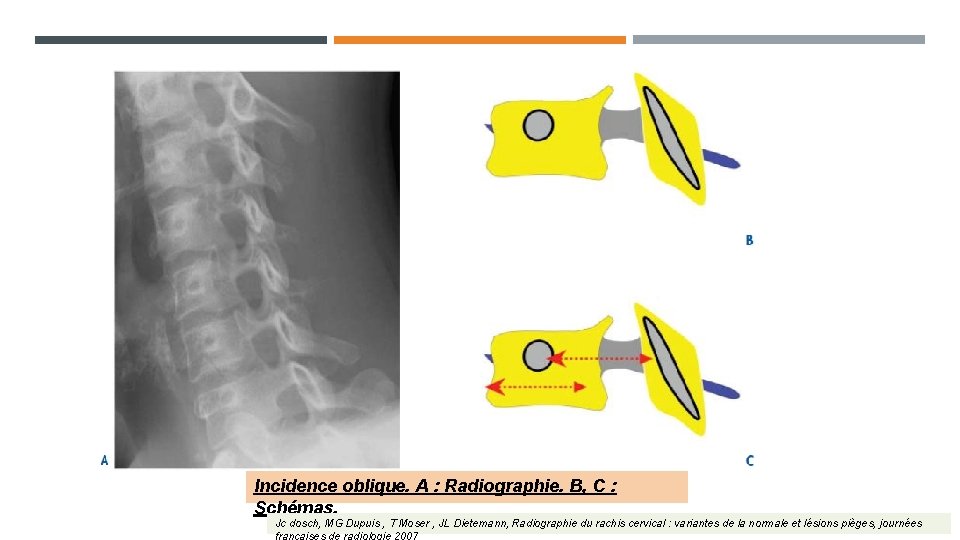 RADIOGRAPHIE DU RACHIS CERVICAL VARIANTES DE LA NORMALE