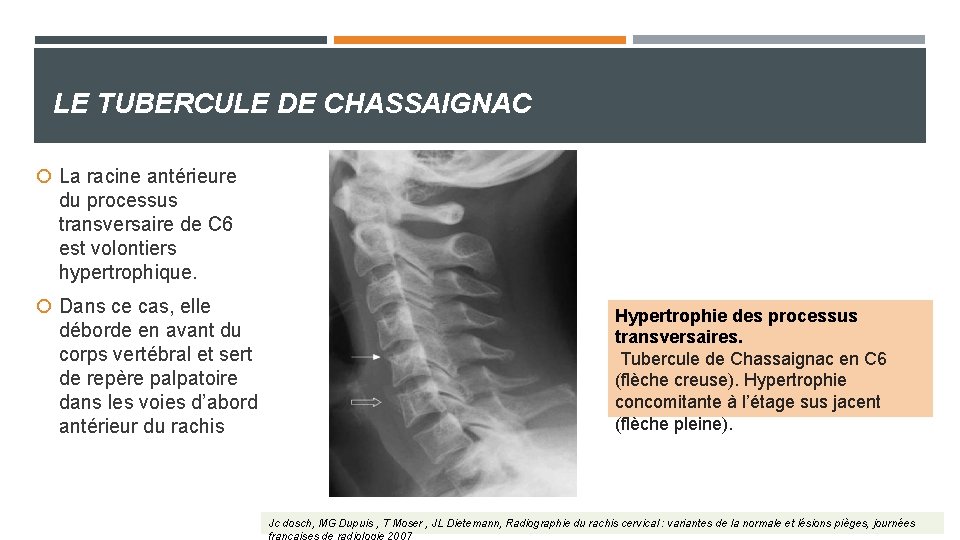 RADIOGRAPHIE DU RACHIS CERVICAL VARIANTES DE LA NORMALE