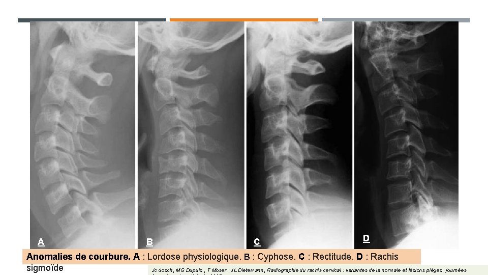 RADIOGRAPHIE DU RACHIS CERVICAL VARIANTES DE LA NORMALE