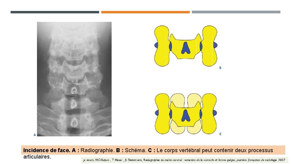 RADIOGRAPHIE DU RACHIS CERVICAL VARIANTES DE LA NORMALE