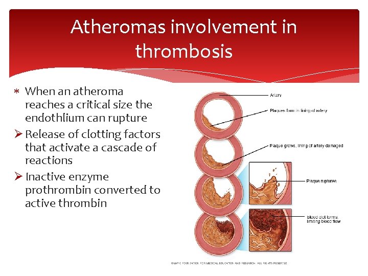 What do I know What is atherosclerosis What