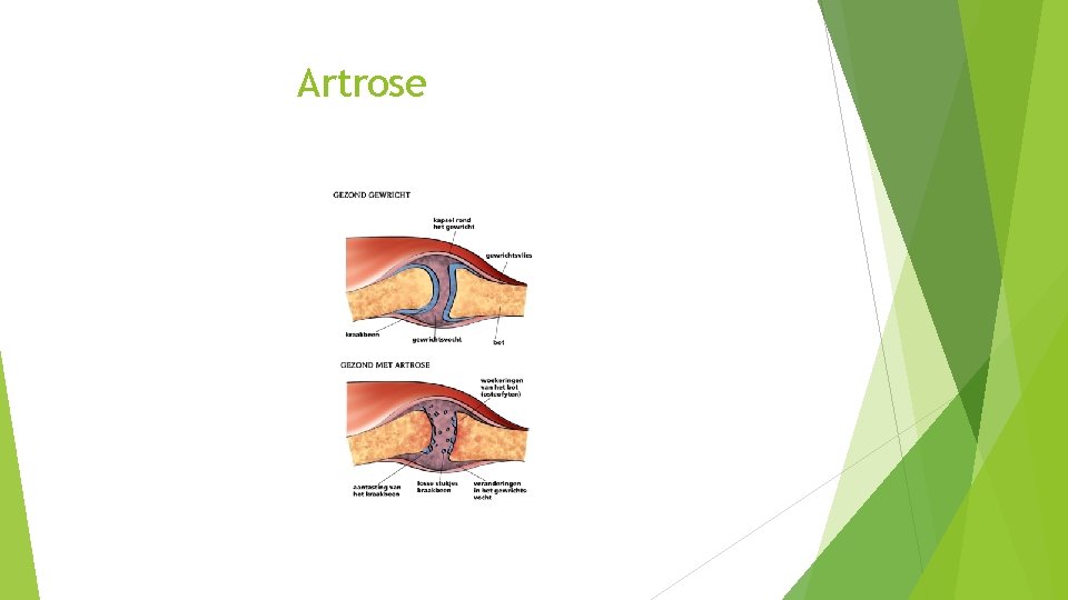 indeling Artrose Artritis Rheumatoide Artritis Fibromyalgie Ziekte van