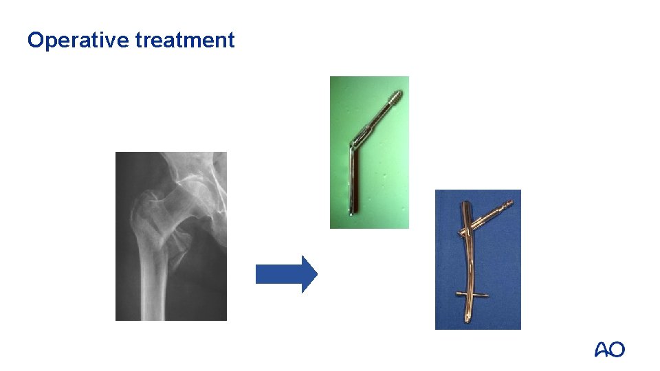Trochanteric fractures AO Trauma Basic Principles Course Learning