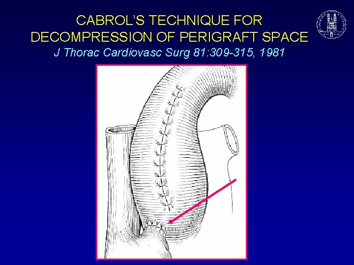 ASCENDING AORTIC ANEURYSM TECHNIQUE MARKO TURINA University Hospital