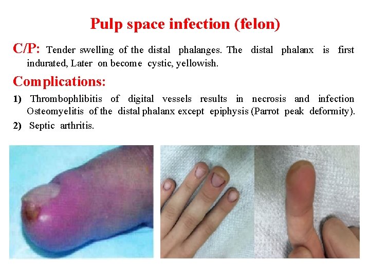 Hand infections Traumatic anurea By Dr Ahmed Rashidy