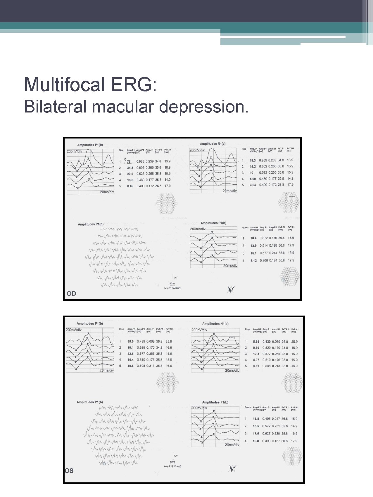 IDIOPATHIC BIG BLIND SPOT SYNDROME AND ACUTE ZONAL
