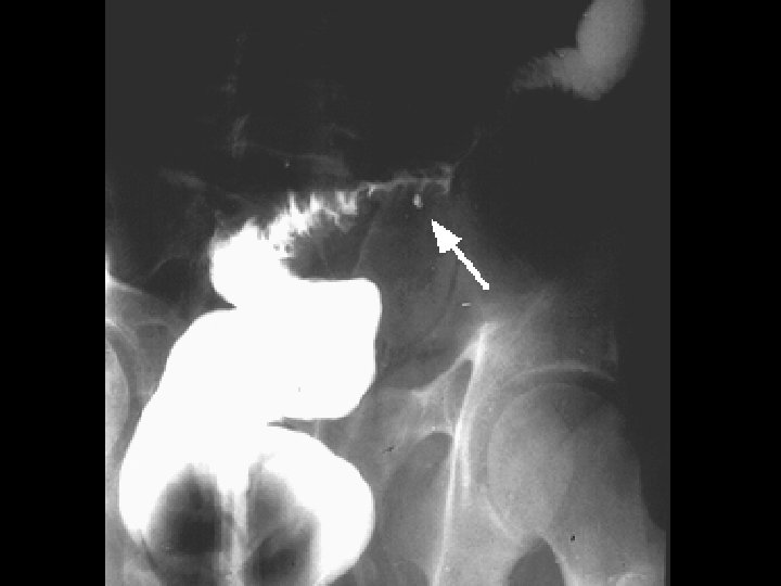 Diverticular Disease Richard Rahdon Objectives Definition Pathology ...