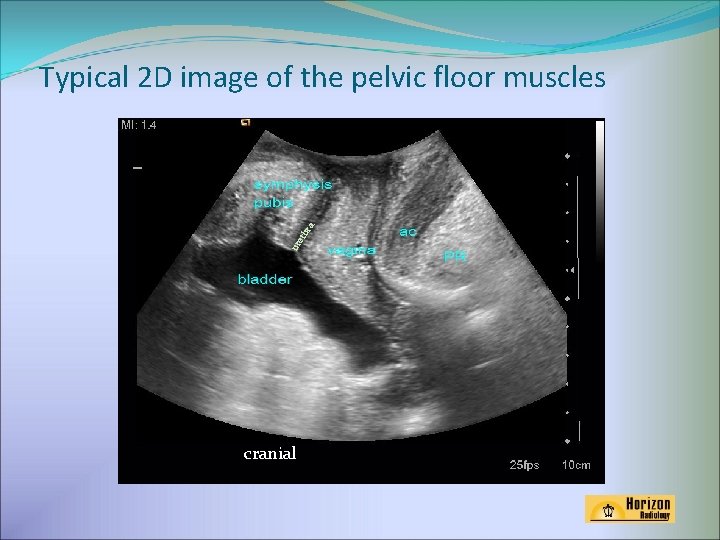 Imaging of the pelvic floor Ultrasound and MRI
