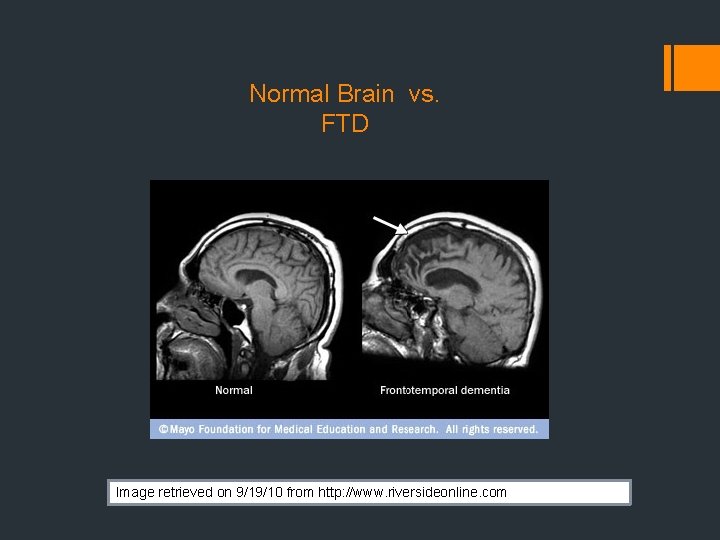 Executive Dysfunction and Language Impairment in Frontotemporal Dementia