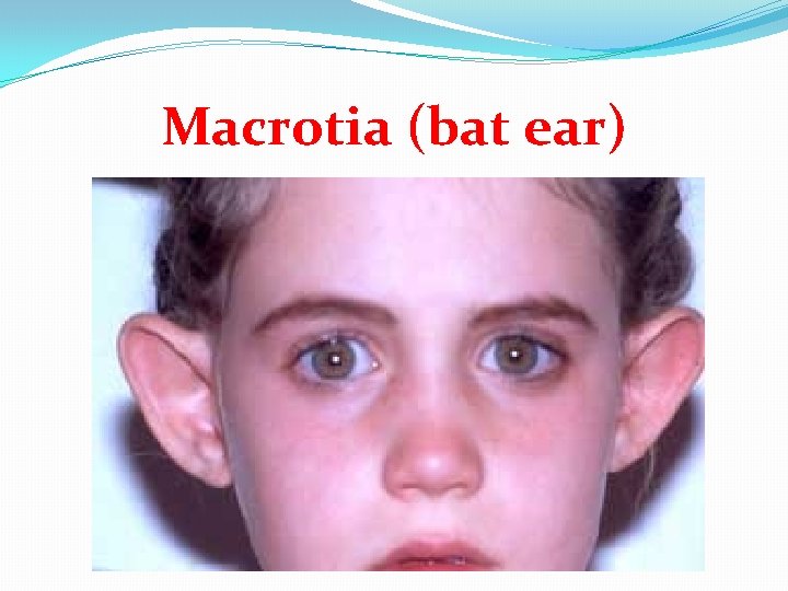 cleft LIP PALATE By DrMohammed M Mubarak Ass