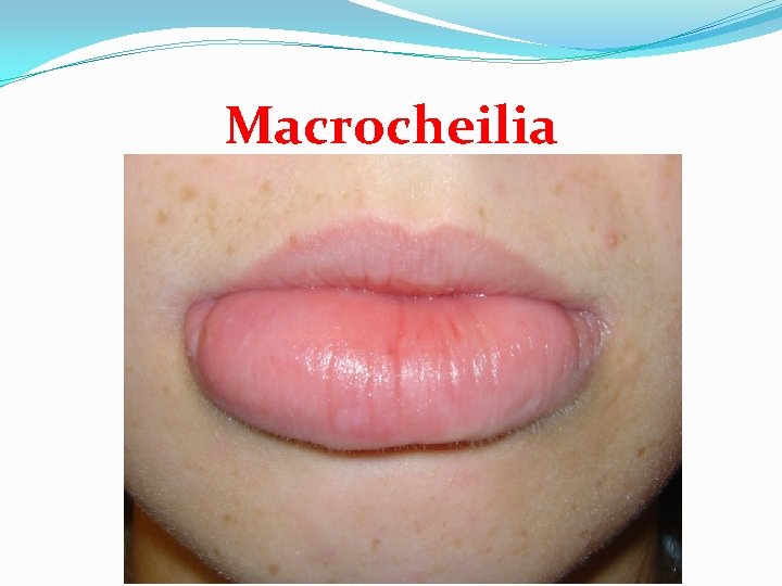 cleft LIP PALATE By DrMohammed M Mubarak Ass