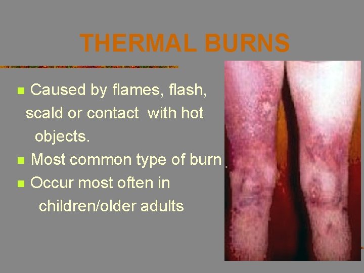 BURNS M GARDNER NUR224 BURNS n Occurs when