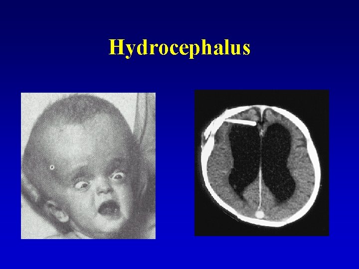 HippelLindau disease Retinal angiomatosis Cerebellar angioma In adult