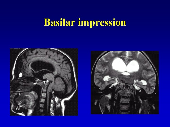 HippelLindau disease Retinal angiomatosis Cerebellar angioma In adult