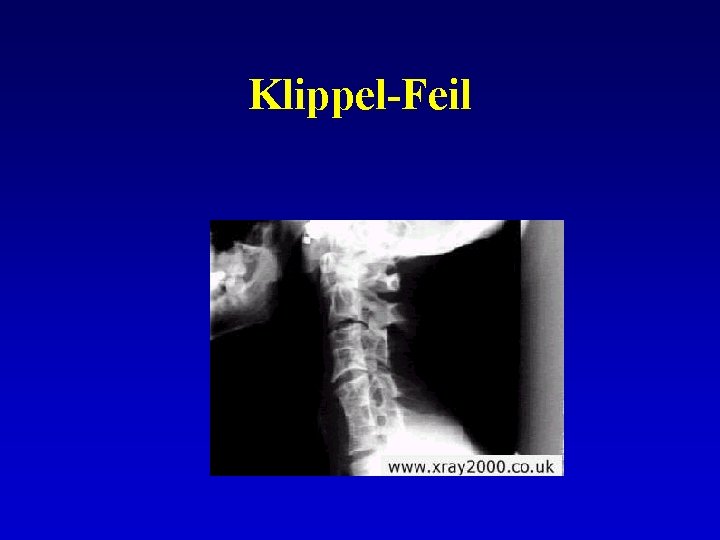 HippelLindau disease Retinal angiomatosis Cerebellar angioma In adult