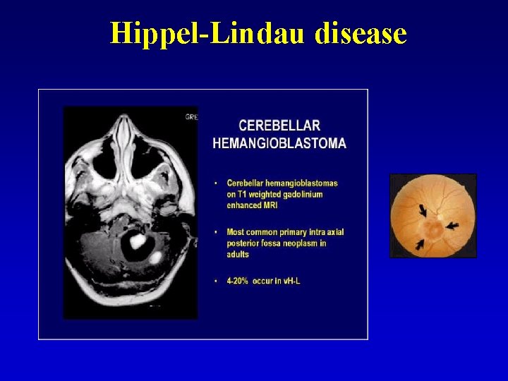 HippelLindau disease Retinal angiomatosis Cerebellar angioma In adult