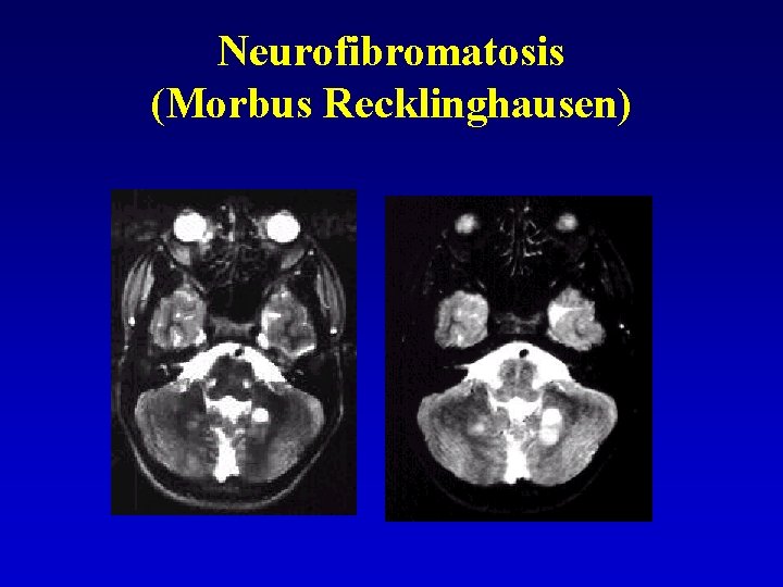 HippelLindau disease Retinal angiomatosis Cerebellar angioma In adult