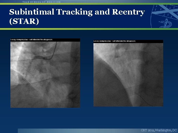 Subintimal Tracking and Reentry for CTO STAR Method