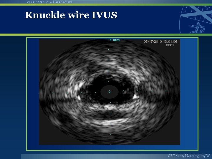 Subintimal Tracking and Reentry for CTO STAR Method