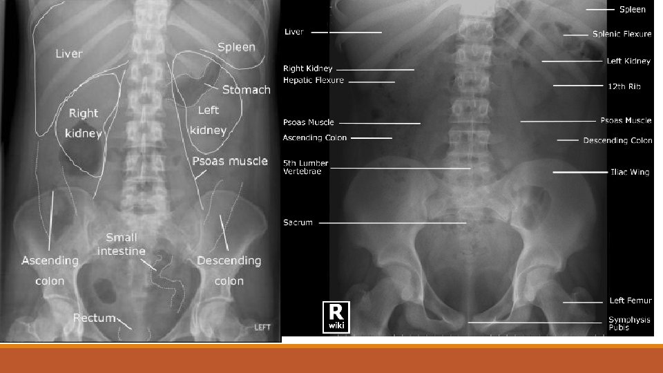 Intro to Radiology Definitions X ray 1 an