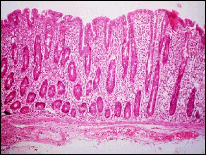 Small intestinal disorders Disorders causing malabsorbtion Celiac disease