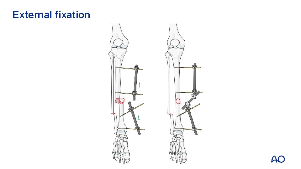 Minimally invasive osteosynthesis minimizing surgical footprints AO Trauma