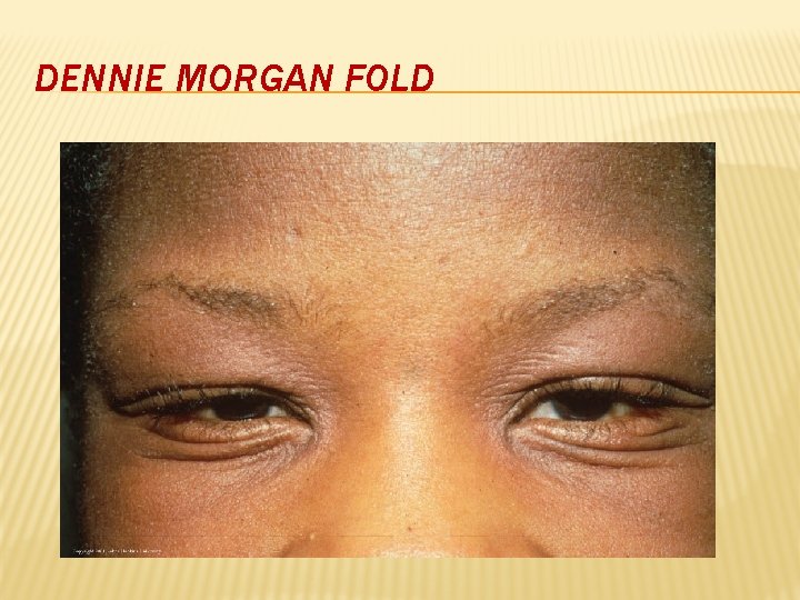 DERMATITIS ECZEMA By DR Eman ALMukhadeb OUTLINE Atopic