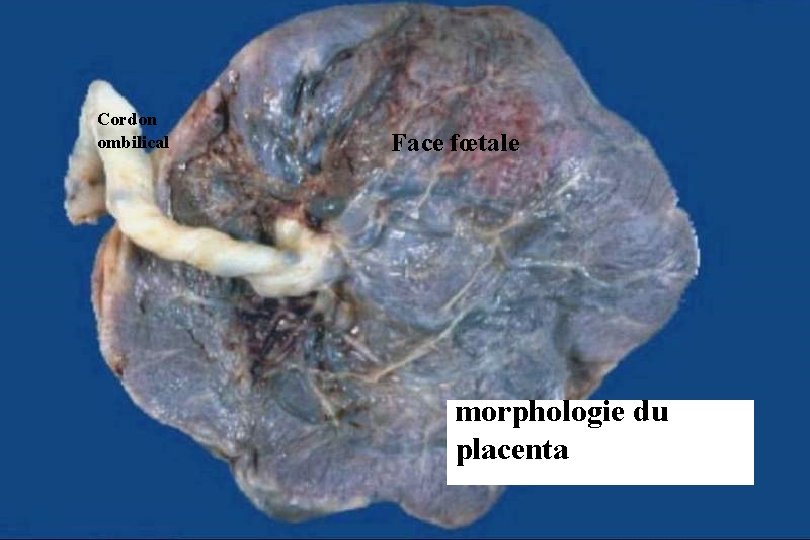 LE PLACENTA Le placenta humain se prsente comme