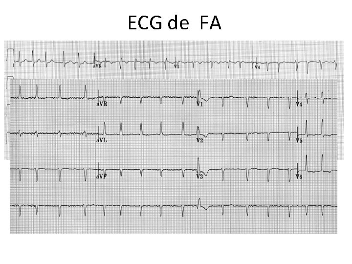 Fibrillation atriale Dr BOUKERTOUTA Tanissia Service de cardiologie