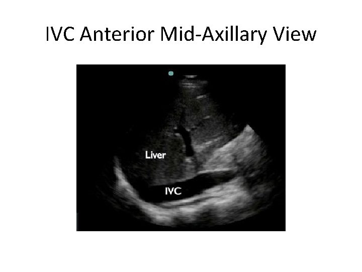 ULTRASOUND OF INFERIOR VENA CAVA OBJECTIVES Describe indications