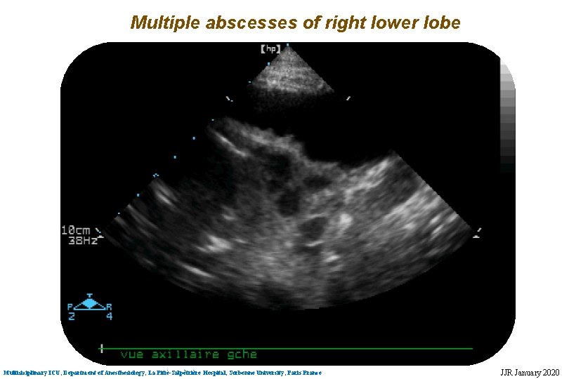Basic skills in transthoracic lung ultrasound Antoine Monsel