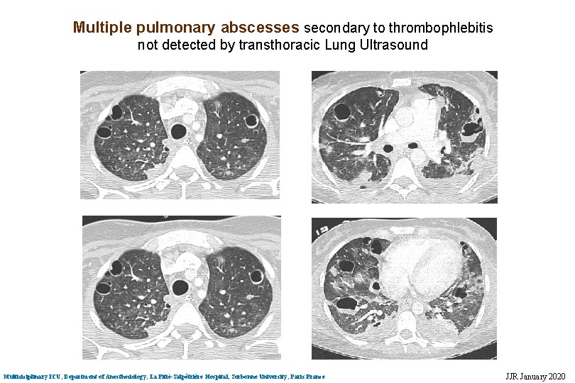 Basic skills in transthoracic lung ultrasound Antoine Monsel