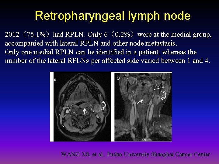 Patterns of lymph node metastasis from nasopharyngeal carcinoma