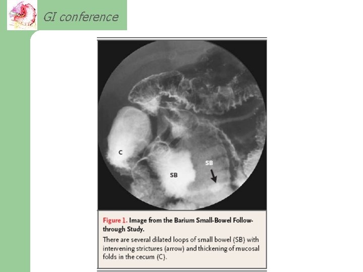 Tb enteritis Department of Surgery GI conference Introduction