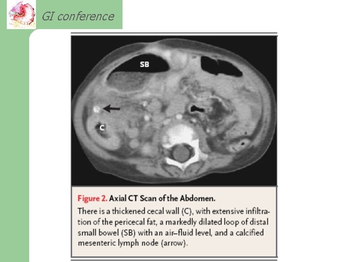 Tb enteritis Department of Surgery GI conference Introduction