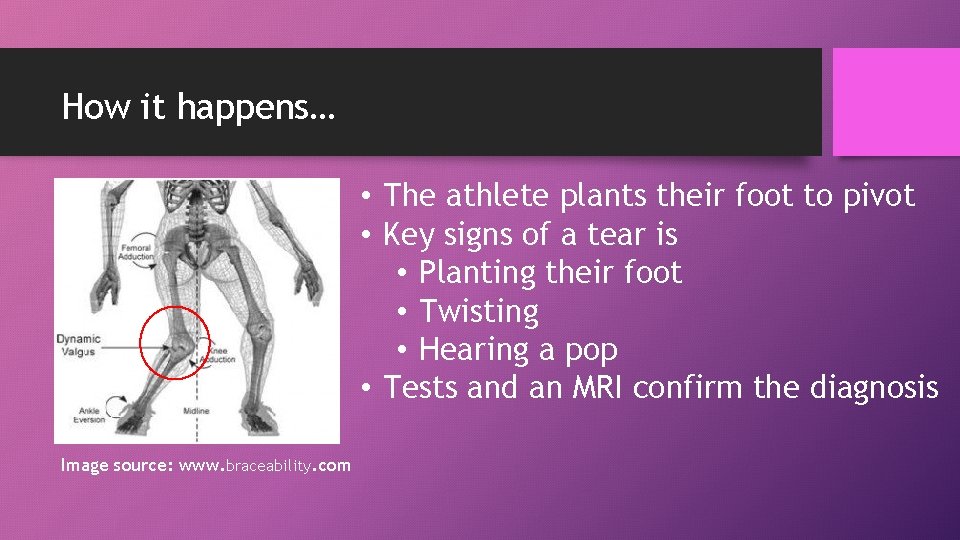 An Athletes Guide to ACL Injury Shelby Money