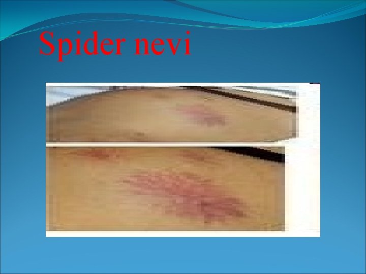 SIROSIS HEPATIS Pengertian kondisi yang menggambarkan keadaan beberapa