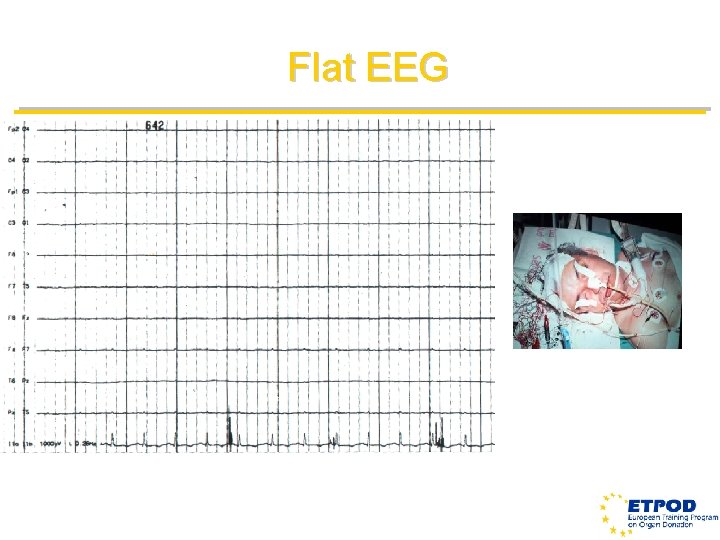 BRAIN DEATH Essentials in Organ Donation The process