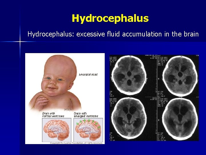 Meninges Cerebro Spinal Fluid CSF Blood Brain Barrier