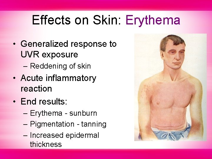 Ultraviolet Therapy Ultraviolet Radiation UVR Electromagnetic spectrum 2000