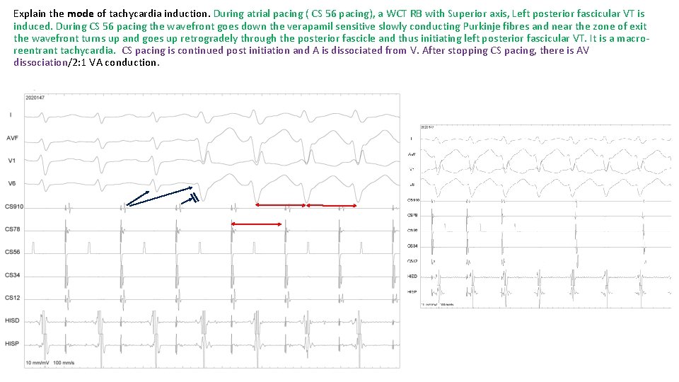 14 yr old boy Recurrent tachycardia episodes Normal