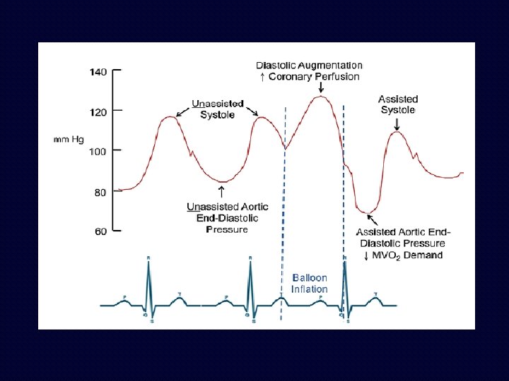 IABP Intraaortic balloon pump counterpulsation Acute circulatory support