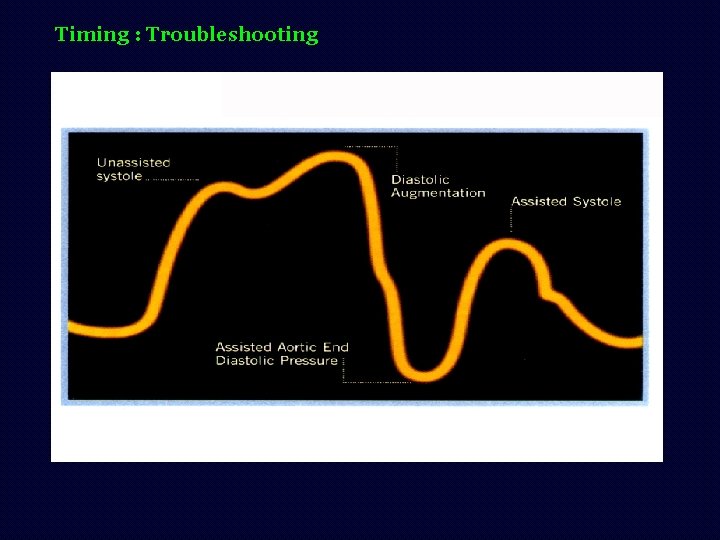 IABP Intraaortic balloon pump counterpulsation Acute circulatory support
