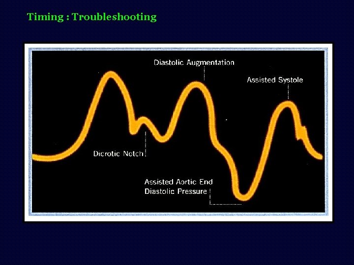 IABP Intraaortic balloon pump counterpulsation Acute circulatory support